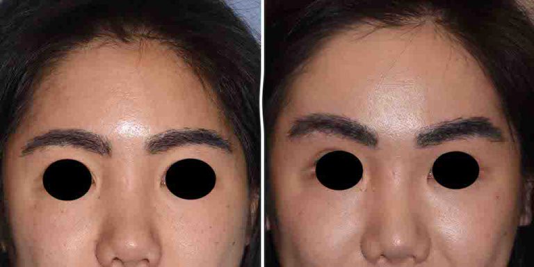 What Type of Custom Forehead Implant Design Can Create a Rounder and ...