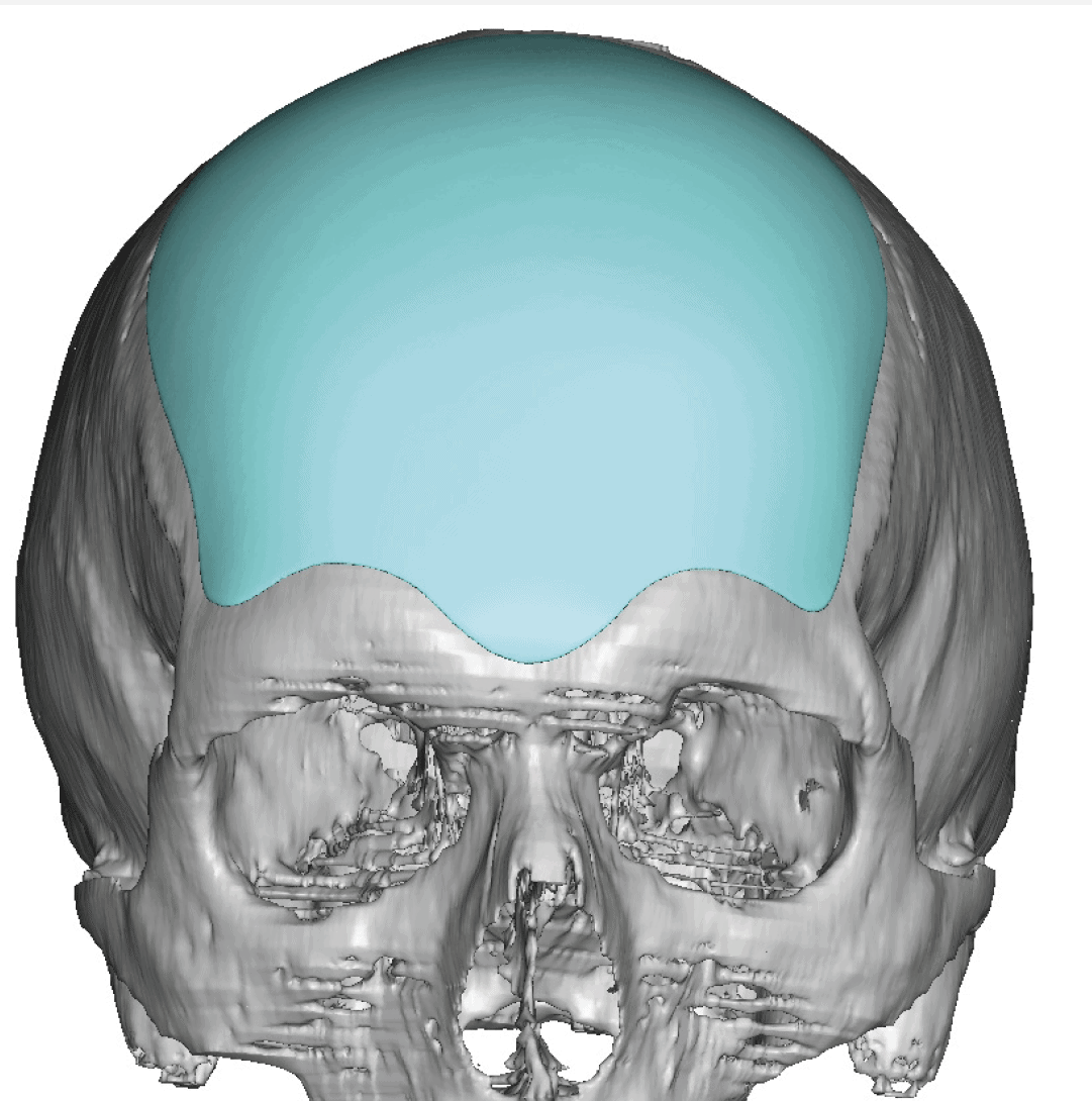 For A Male Forehead Augmentation Should I have A Custom Forehead ...