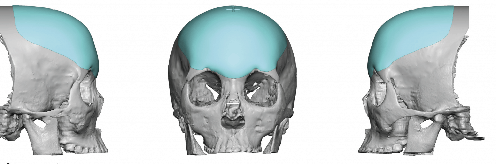 What Type of Custom Forehead Implant Design Can Create a Rounder and ...