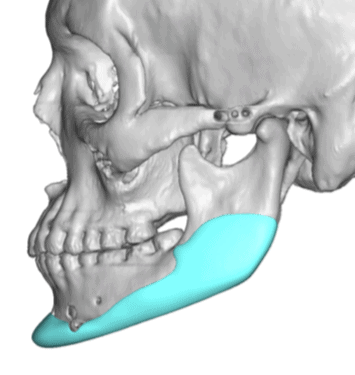What Is The Best Method For VLine Surgery Reversal? - Plastic Surgeon ...