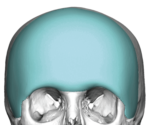 What Type Of Custom Forehead Implant Do I Need? - Plastic Surgeon | Dr ...