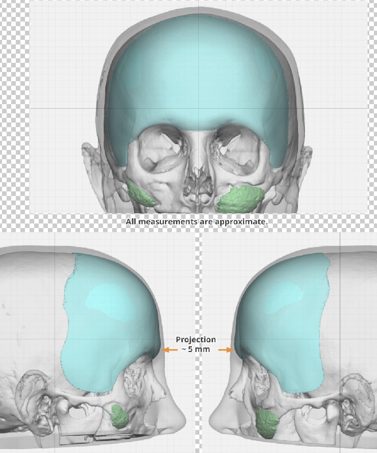 Can I Have A Custom Forehead Implant That Will Make My Upper Face Wider ...