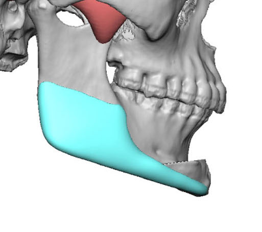 Can You Combine A Sliding Genioplasty With A Custom Jawline Implant Plastic Surgeon Dr can-you-combine-a-sliding-genioplasty-with-a-custom-jawline-implant-plastic-surgeon-dr