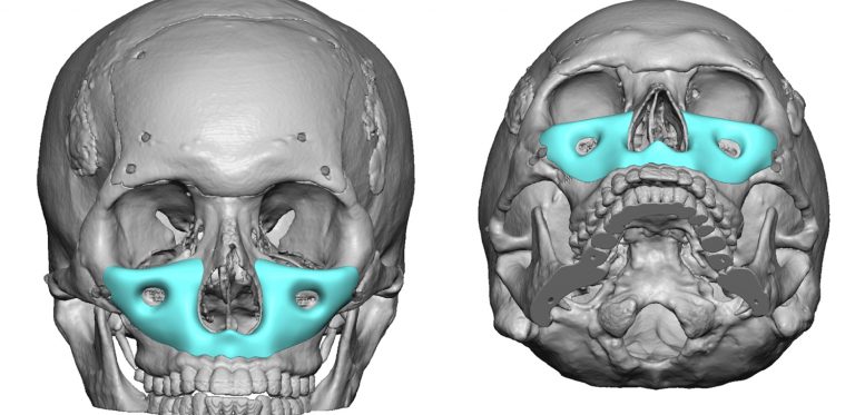 Will A Custom Midface Mask Implant Help My Recessed Midface Situation ...