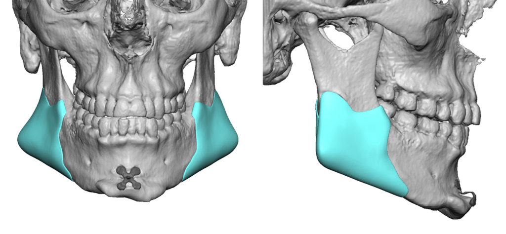 What Type of Custom Jaw Angle Implant Design Do I Need For This Look ...