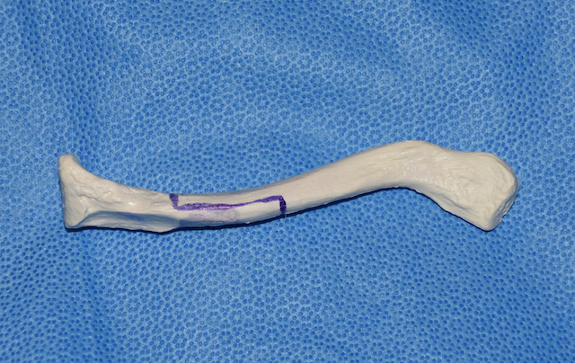 Which Shoulder Widening (Clavicle Lengthening) Technique Works The Best ...