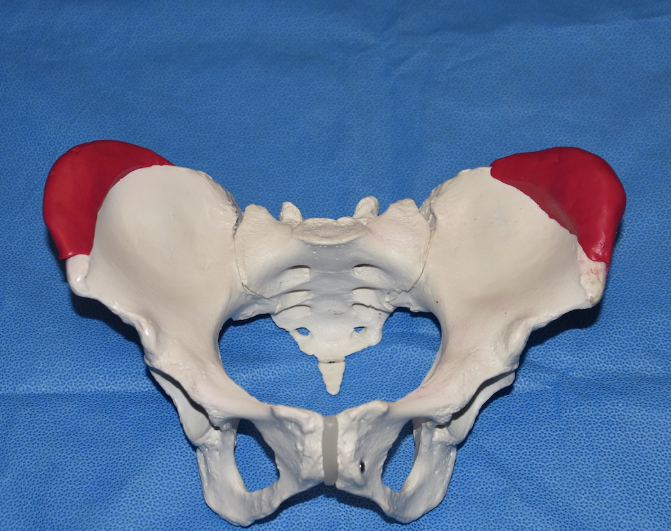 Am I A Good Candidate For Iliac Crest Implants Plastic Surgeon Dr Barry L Eppley Md