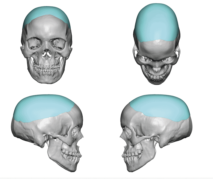 Can Scaphocephaly Head Shape Be Treated As An Adult? - Plastic Surgeon ...