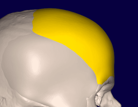 Should A Forehead Augmentation Go Further Back Onto The Top Of The ...