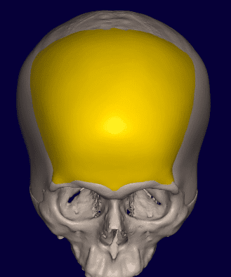 Should A Forehead Augmentation Go Further Back Onto The Top Of The ...