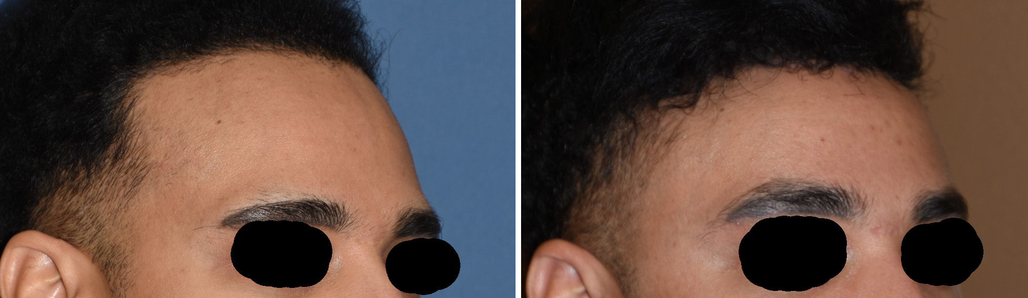 Which Is Better For Forehead Reduction - Hairline Advancement or Hair ...
