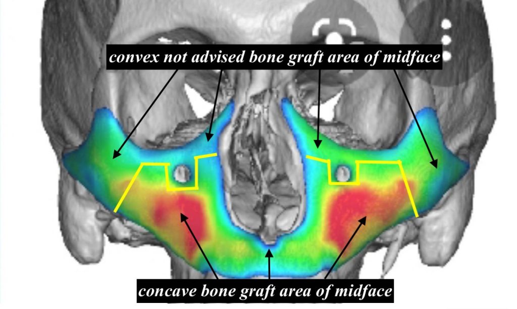 Can I Use Cranial Bone Grafts For Midface Augmentation? - Plastic ...