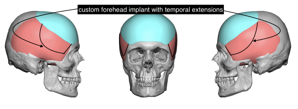 How Can A Sloping Forehead With Temporal Hollowing Be Corrected ...