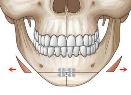 Should I have Hypedynamic Chin Ptosis Correction Before or After Mini-V ...