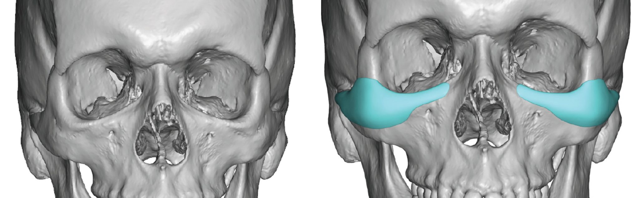 Are Custom infraorbital-Malar Implants The Right Choice For My Face ...