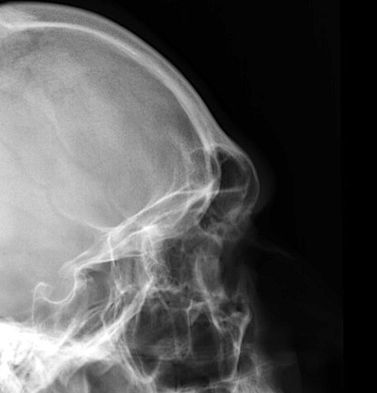 Why Is One Of My Brow Bones Bigger Than The Other? - Plastic Surgeon ...