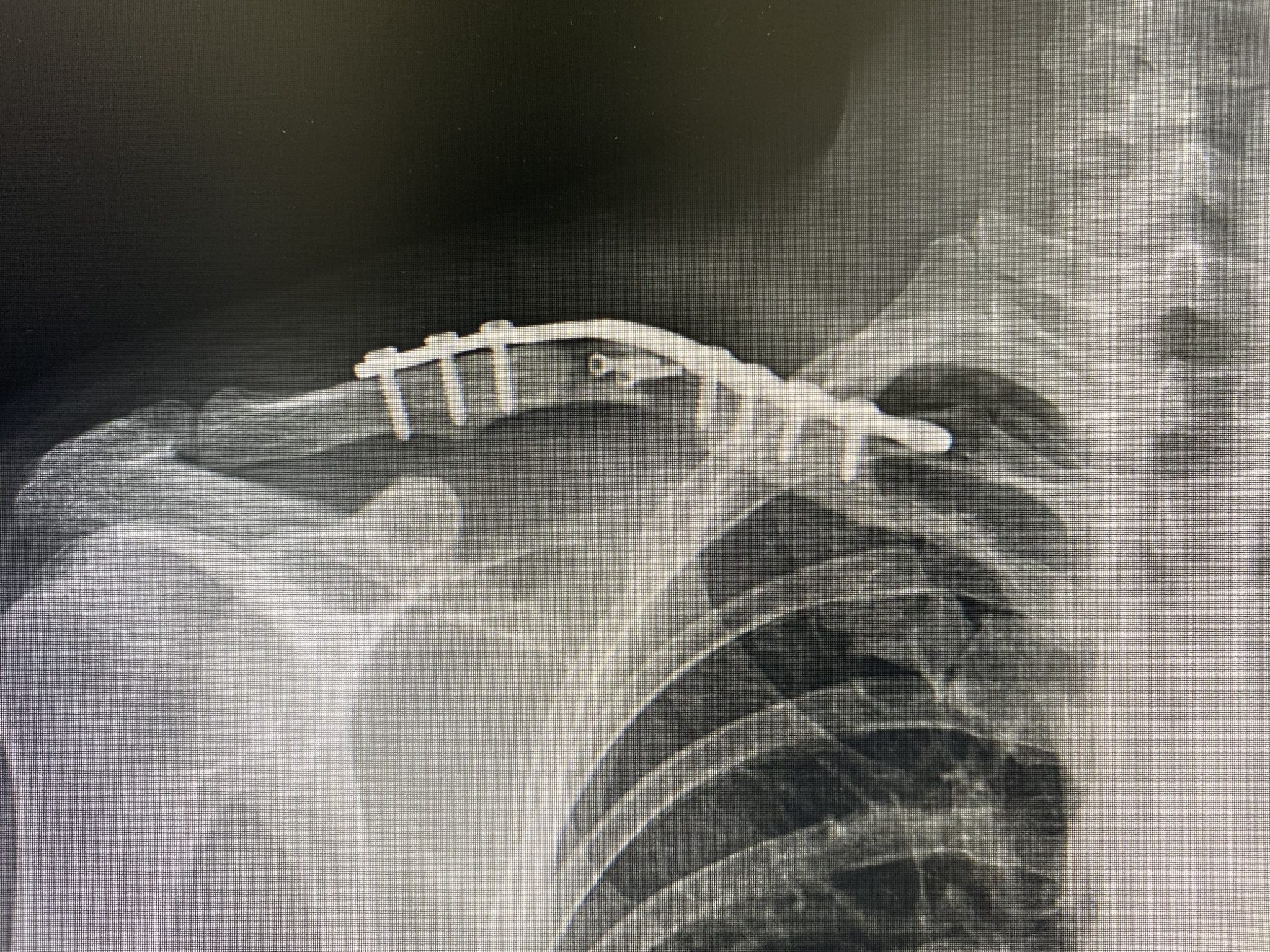 Shoulder Narrowing & Widening Surgery - Plastic Surgeon | Dr. Eppley