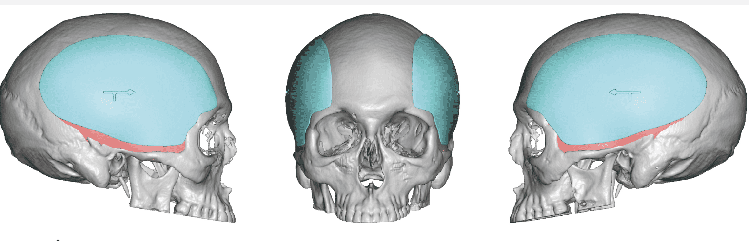 What Type Of Temporal Implant Do I Need For A Wider Head Shape ...