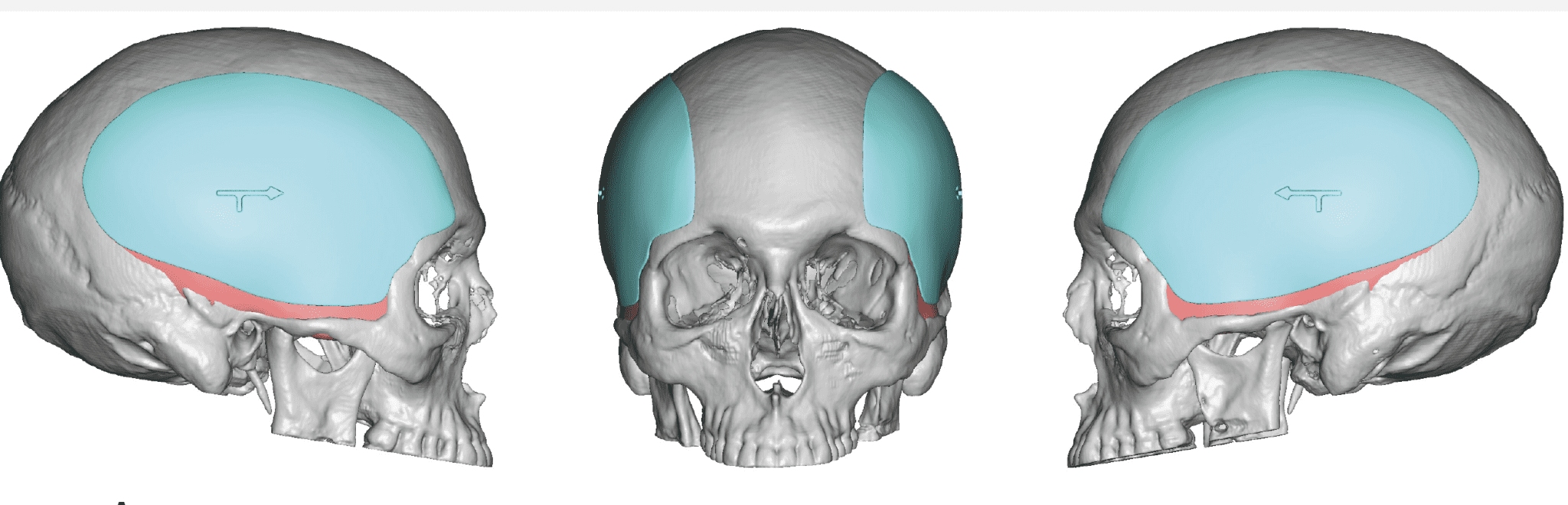 What Type Of Temporal Implant Do I Need For A Wider Head Shape ...