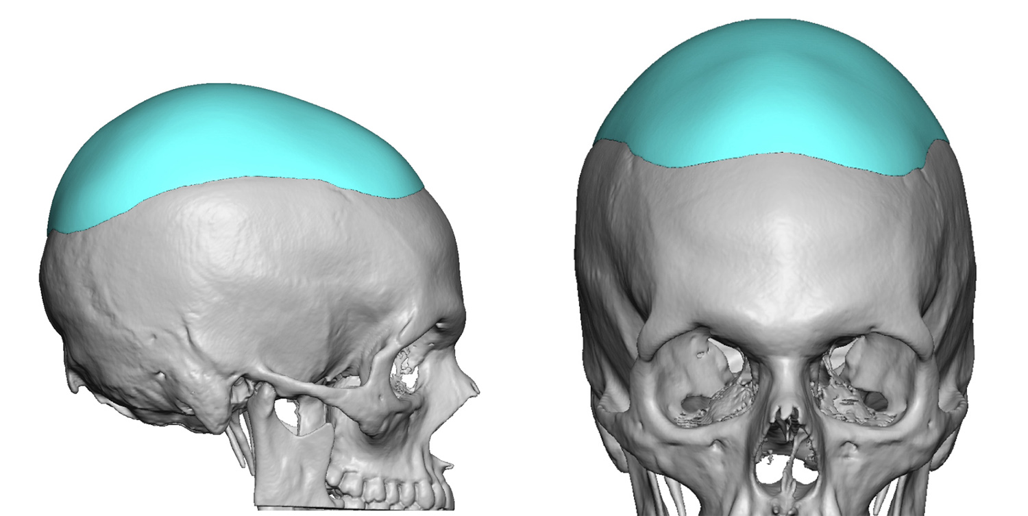 How Can I Make My Head Shape More Symmetric and Rounder? - Plastic ...
