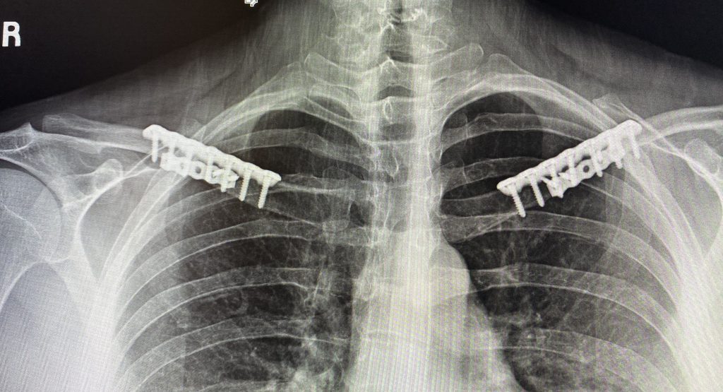 Shoulder Narrowing & Widening Surgery - Plastic Surgeon