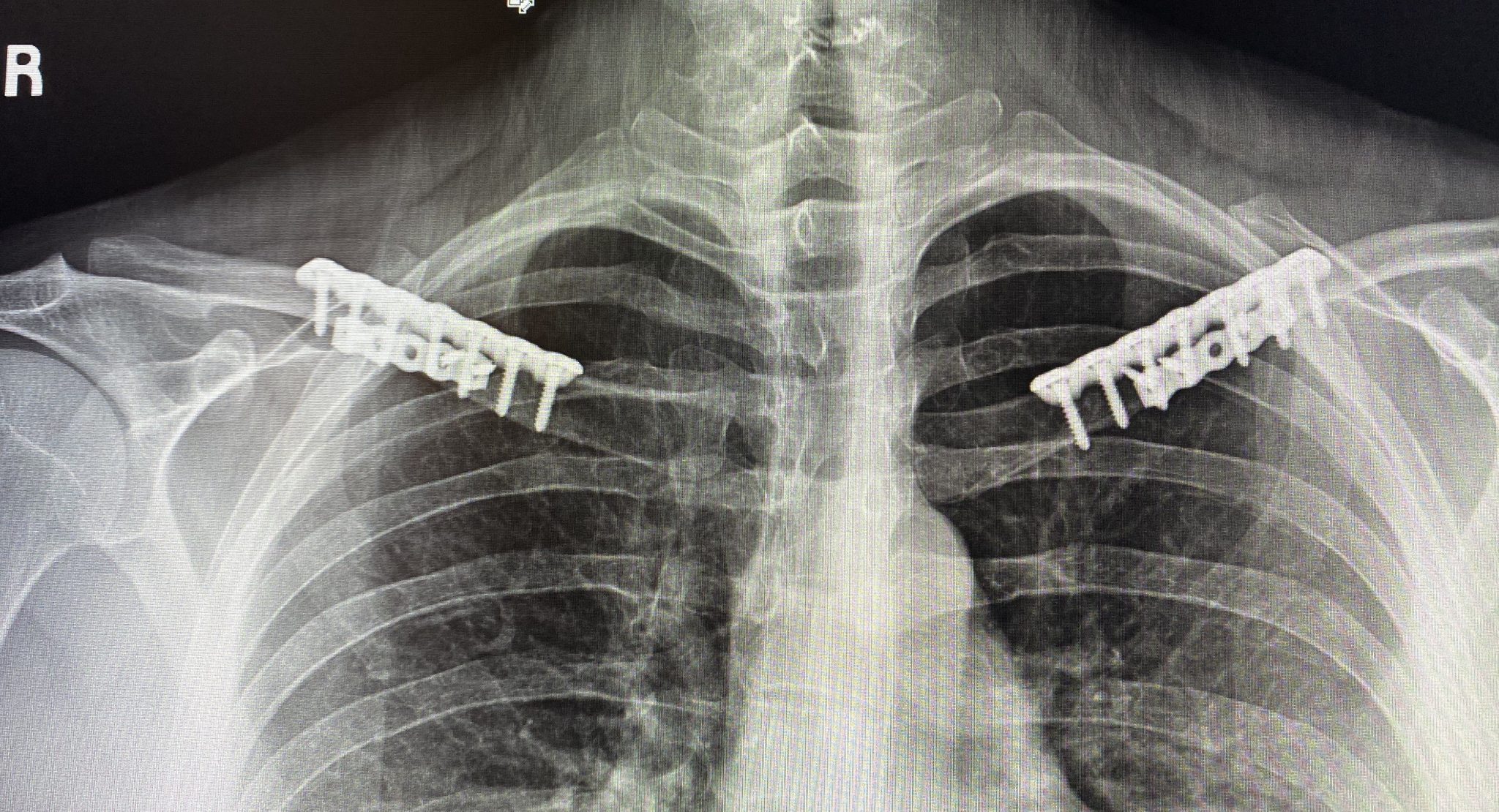 Shoulder Reshaping Surgery - Shoulder/Clavicle Reduction