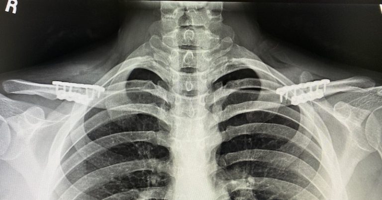 Shoulder Reshaping Surgery - Shoulder/Clavicle Reduction