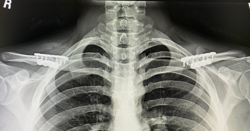 Shoulder Reshaping Surgery - Shoulder/Clavicle Reduction