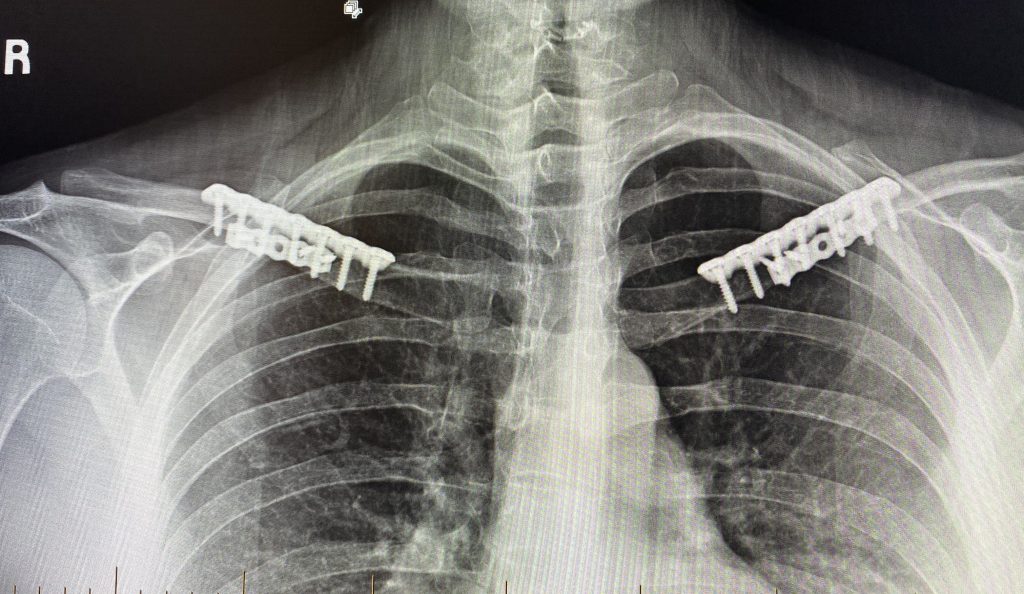 Shoulder Narrowing & Widening Surgery - Plastic Surgeon