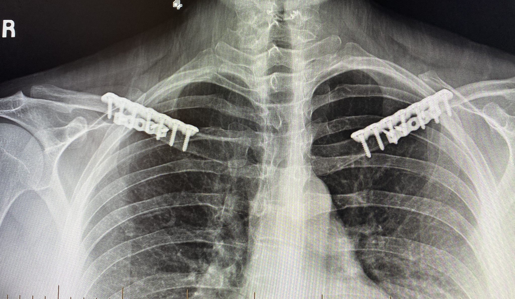 Shoulder Reshaping Surgery - Shoulder/Clavicle Reduction