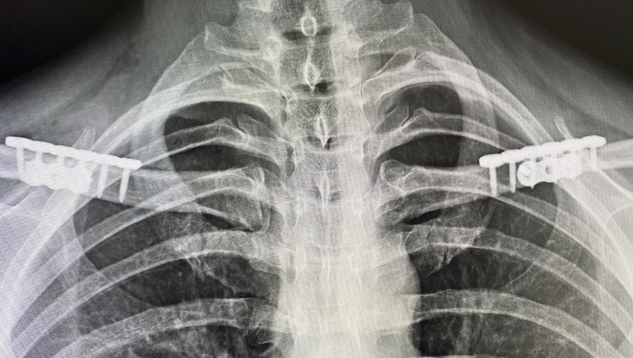 Shoulder Reshaping Surgery - Shoulder/Clavicle Reduction