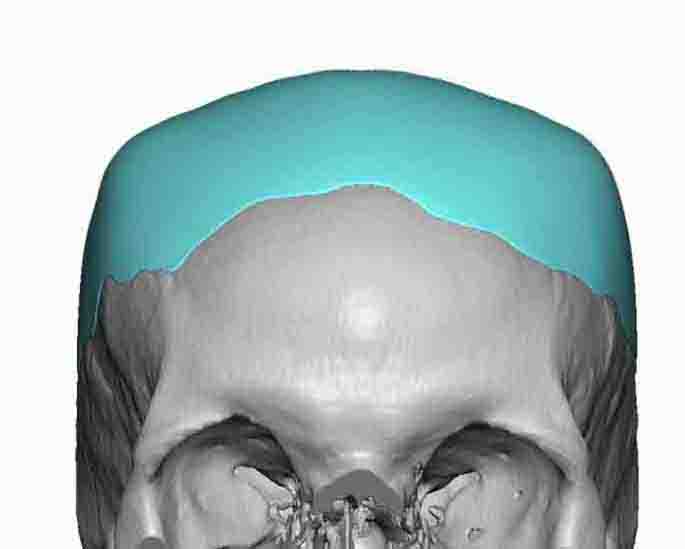 Can A Skull Implant Make A More Square Head Shape? - Plastic Surgeon ...