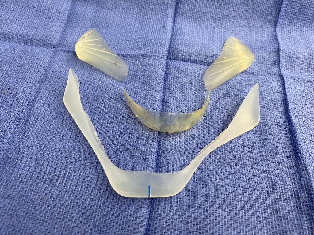 Will Standard Chin and Jaw Angle Implants Create A Smooth and ...