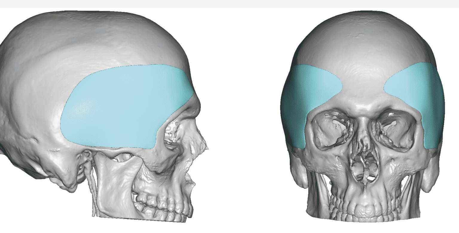 How Can I Make My Forehead Wider And Camouflage Prominent Zygomatic ...
