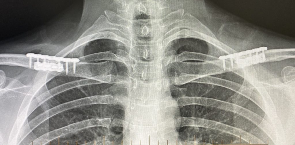 Shoulder Reshaping Surgery - Shoulder/Clavicle Reduction