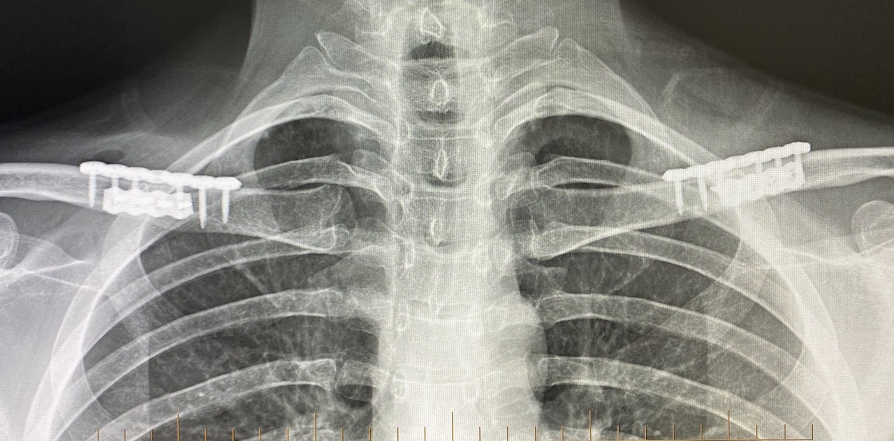 Shoulder Reshaping Surgery - Shoulder/Clavicle Reduction