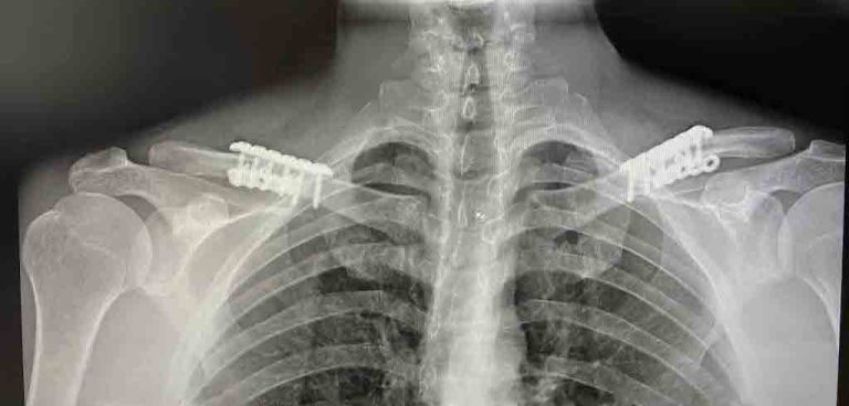 Shoulder Reshaping Surgery - Shoulder/Clavicle Reduction