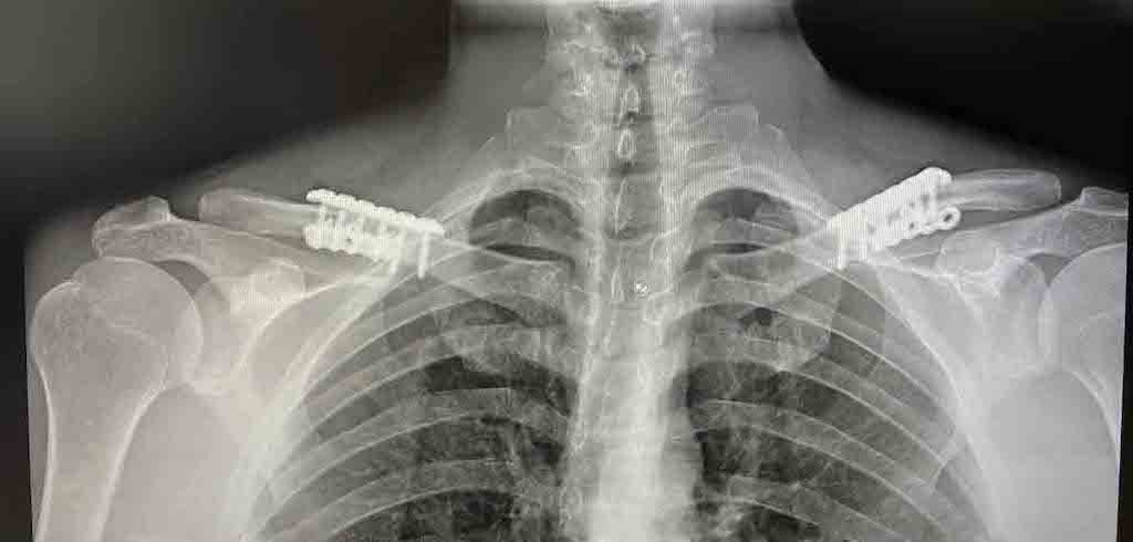 Shoulder Reshaping Surgery - Shoulder/Clavicle Reduction
