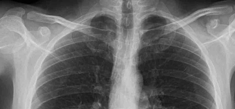 Shoulder Reshaping Surgery - Shoulder/Clavicle Reduction
