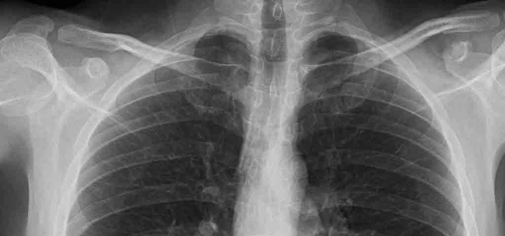 Shoulder Reshaping Surgery - Shoulder/Clavicle Reduction