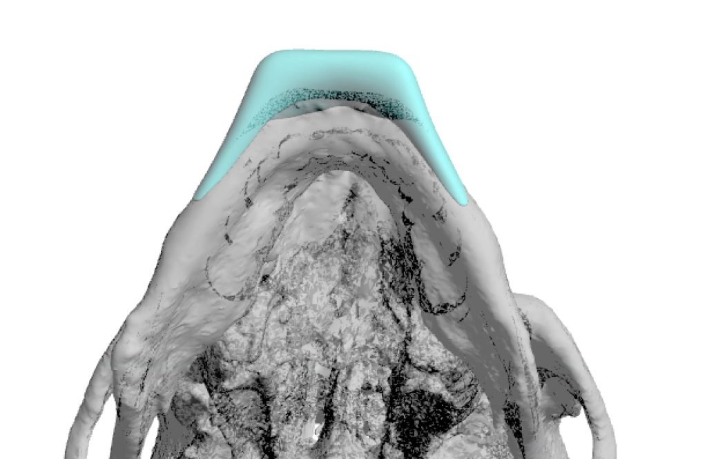 Can You Do A Custom Square Chin. Implant? - Plastic Surgeon | Dr. Barry ...