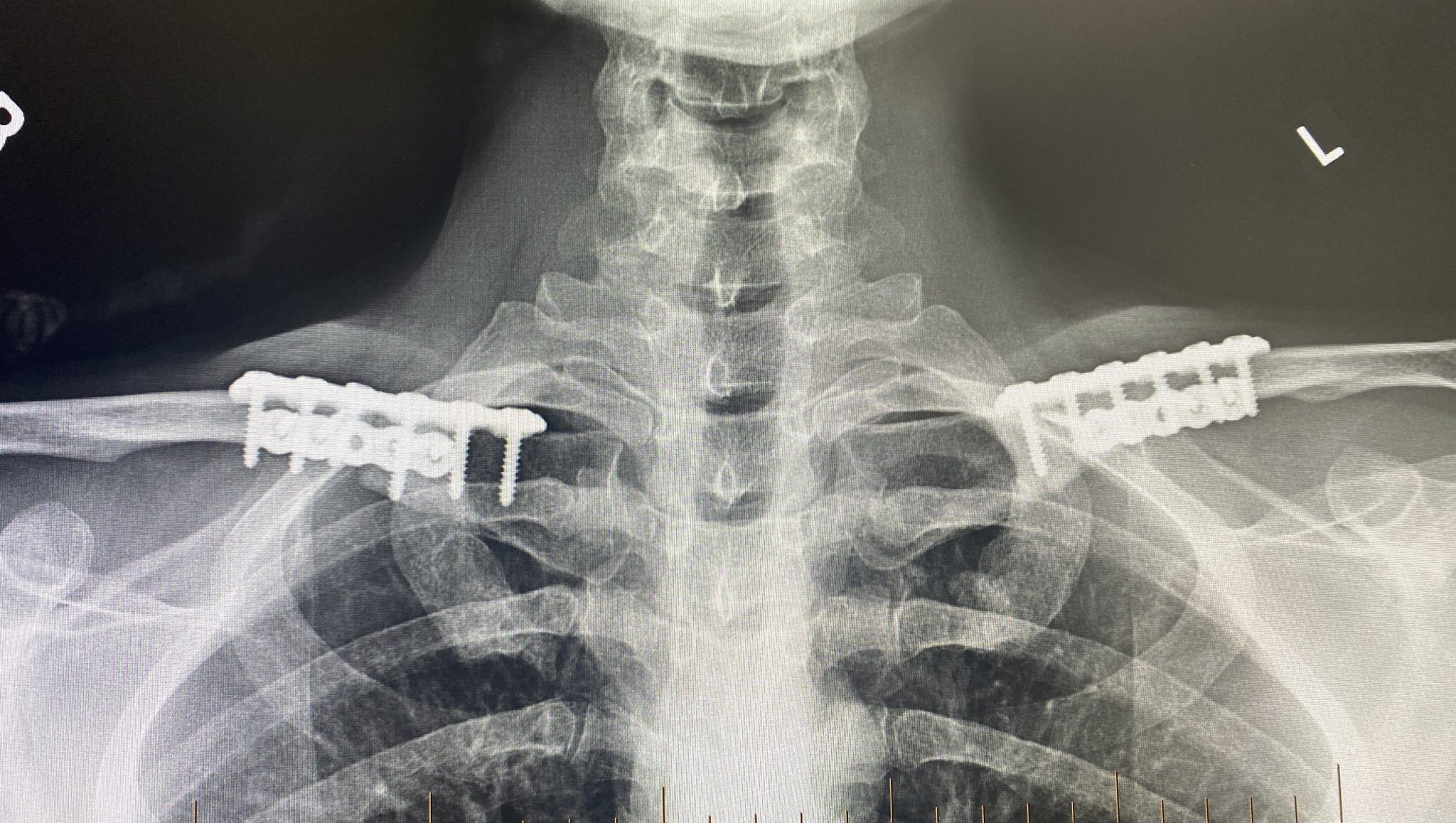 Shoulder Reshaping Surgery - Shoulder/Clavicle Reduction
