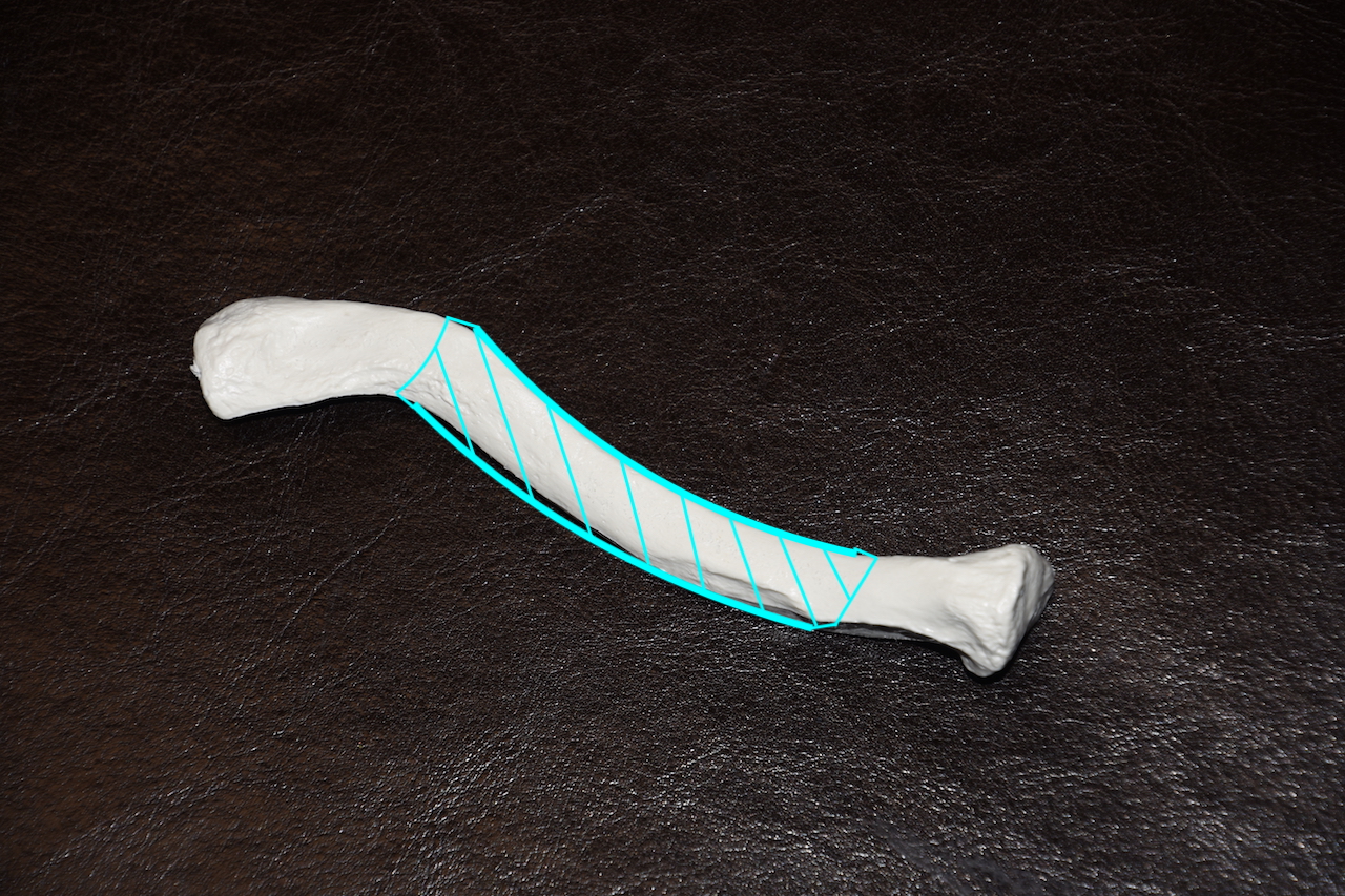 Are There Implants For Clavicle Augmentation? - Plastic Surgeon | Dr ...