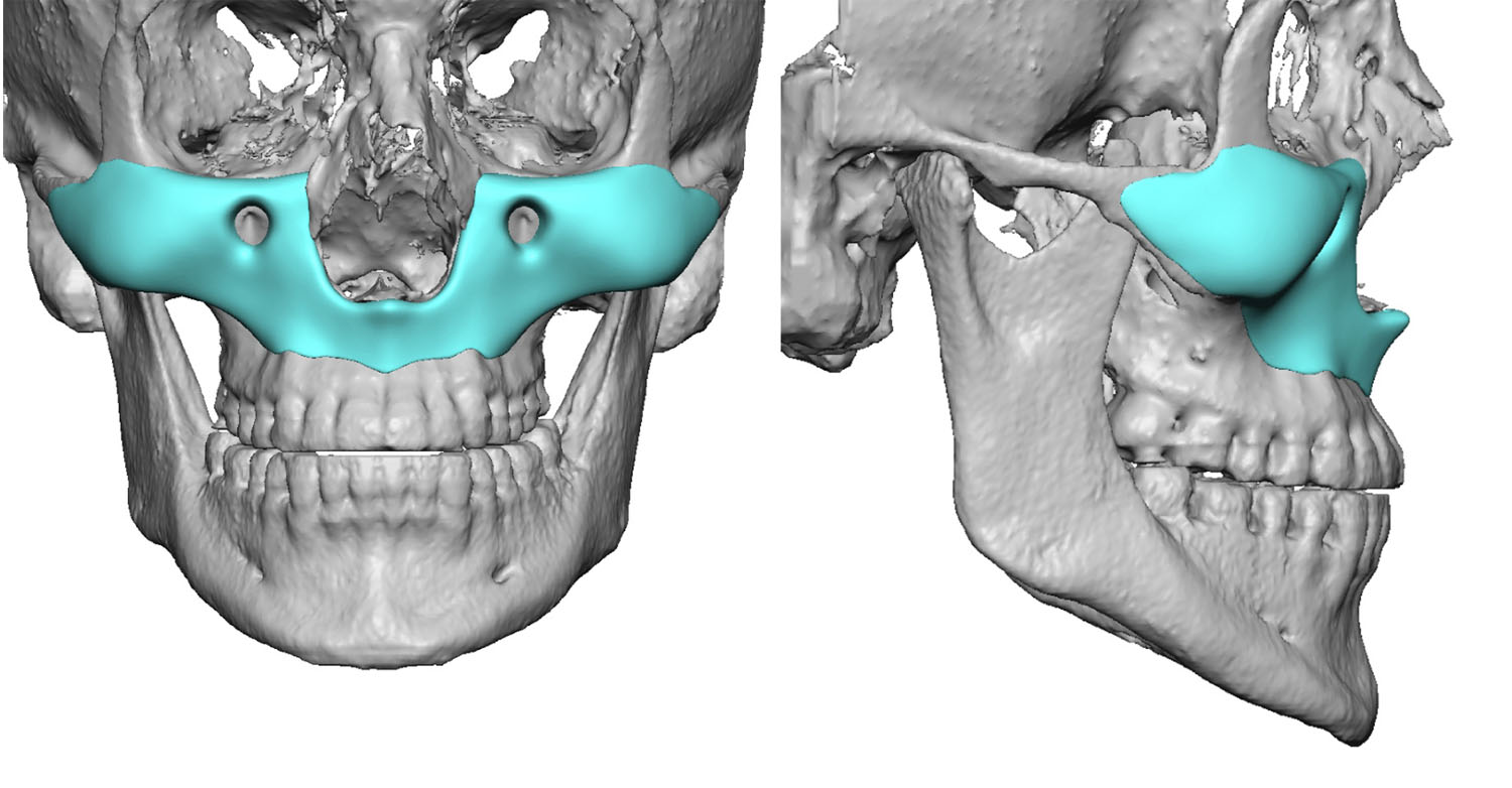 Can My Flat Midface Be Fixed With A Custom Midface Mask Implant ...