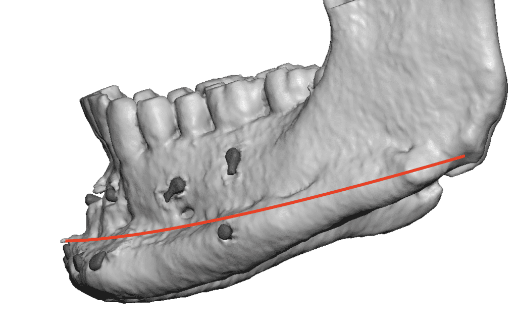 Should I Have The Chin Wing or Custom Jawline Implant For Total Jaw ...