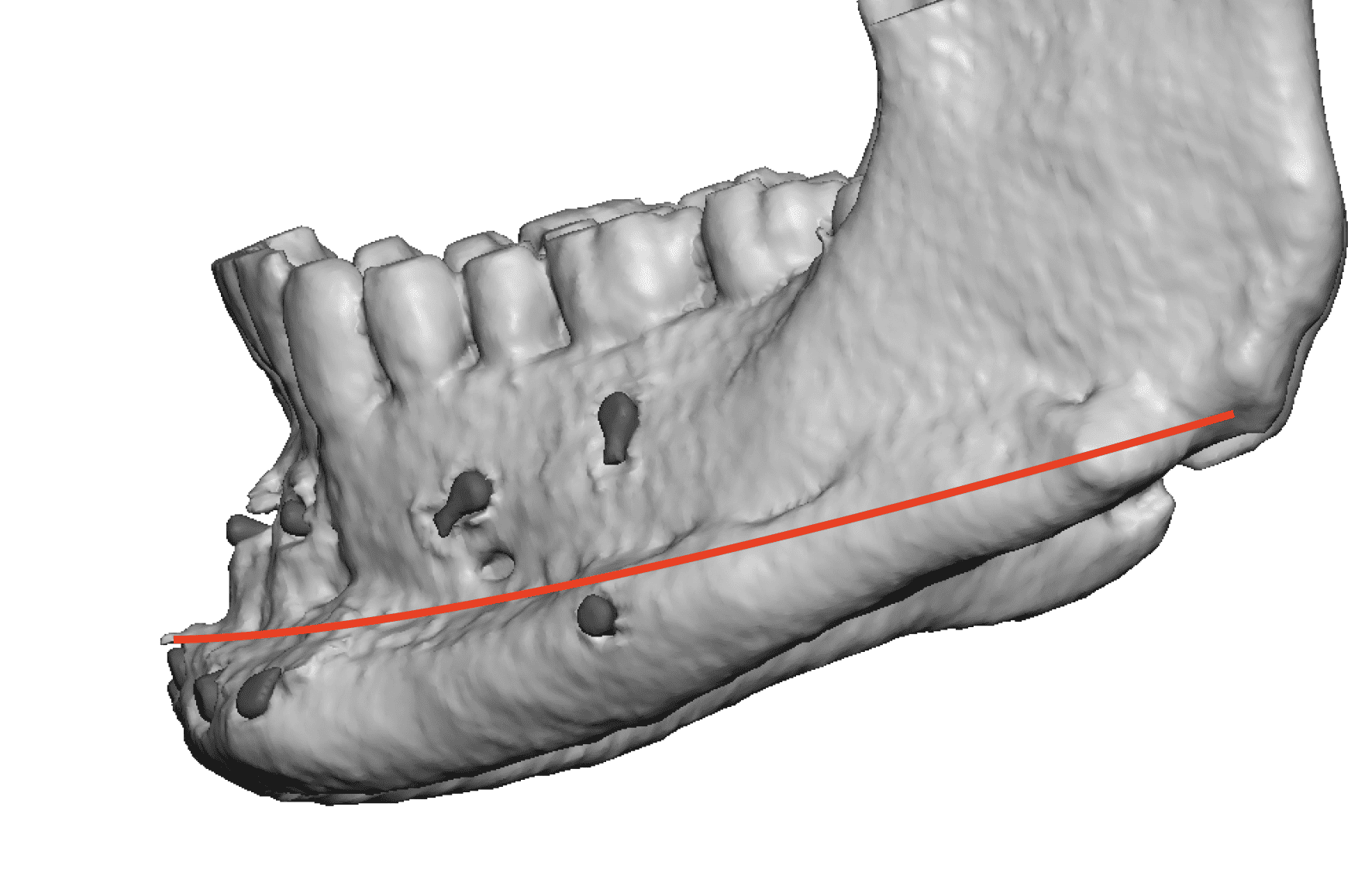Should I Have The Chin Wing or Custom Jawline Implant For Total Jaw ...