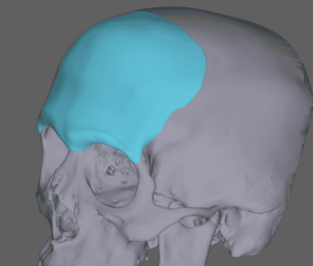 What Surgery Do I Need To Make My Forehead and Eyebrow Bones Pop Out ...