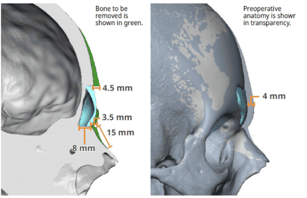 Does Brow Bone Reduction Surgery Need 3D Computer Planning? - Plastic ...