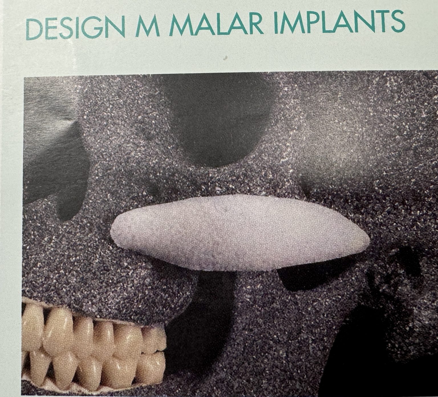 What Type Of Medpor Cheek Implants Do I Have? - Plastic Surgeon | Dr ...