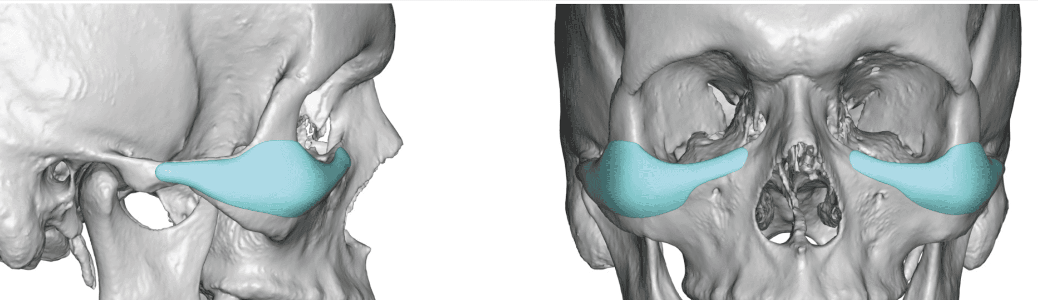 Can I Have Infraorbital-Malar Implants After Lateral Canthoplasties and ...